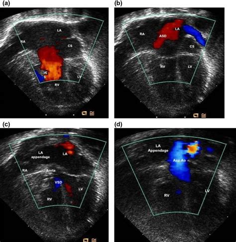 A D Juxtaposition Of The Left Atrial Appendage To The Right Apical