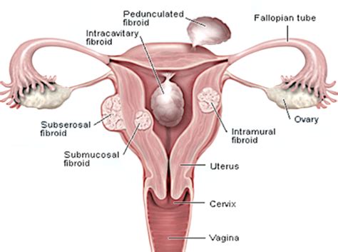 Myomectomy All You Need To Know The Operating Room Global Torg