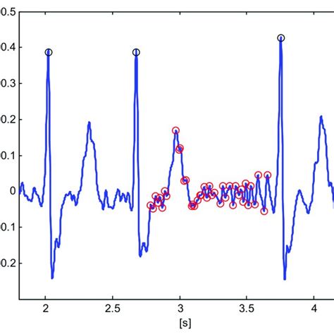 Signal Processing For The Detection Of Rbbb File H03947 Rbbb