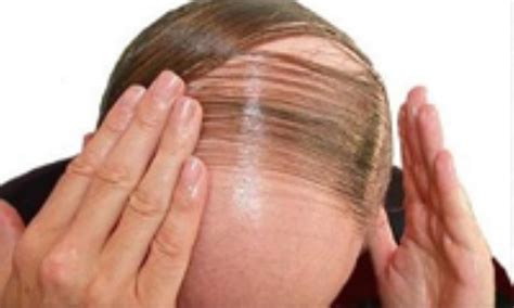 نقش ژن در ريزش مو