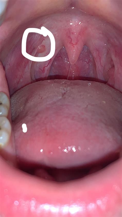 Red Pimple In Throat R Diagnoseme