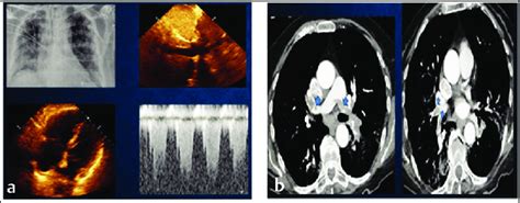 A And B Chest X Ray Depicting Bilateral Interstitial Infiltrates Download Scientific