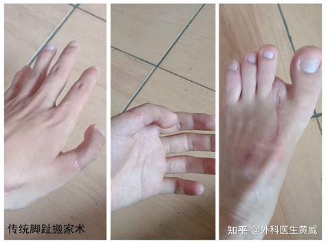 【科普】关于断指再植、再造你需要了解这些！ 知乎