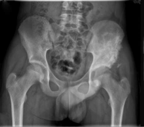 Osteosarcoma Of The Pelvis Bone And Joint