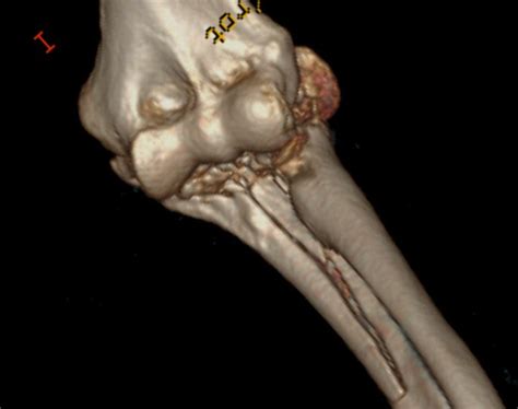 Complex Monteggia Like Fracture Dislocation With Coronoid Deficiency