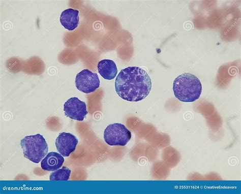 Acute Myelocytic Leukemia Seen On Peripheral Blood Smear Stock