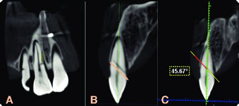 A Corrected Cbct Coronal Image Of 11 With An Incomplete Hrf Fracture