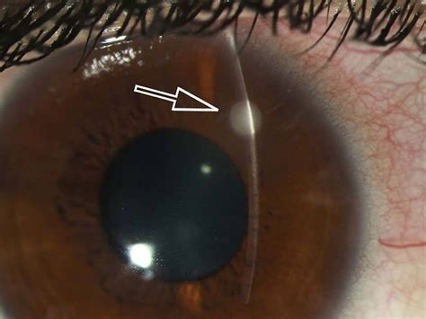 Cornea Infectious Keratitis The Elza Institute Dietikon Zurich