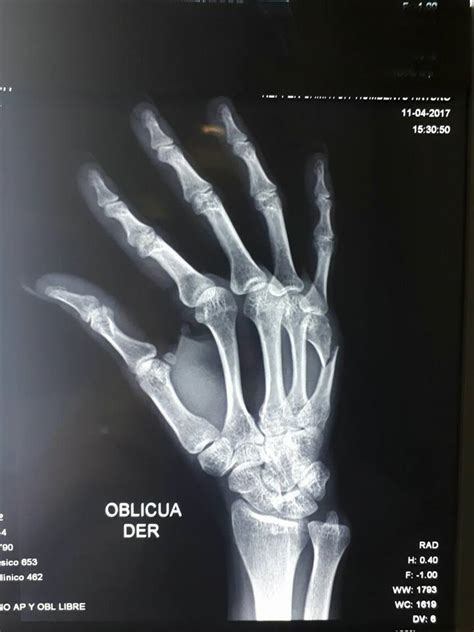 Fractura De 5to Metacarpiano Dr Humberto Kepfer S Facebook