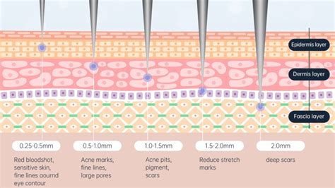 The Ideal Microneedling Depth For Deep Acne Scars Professional Guidelines Mico Aes