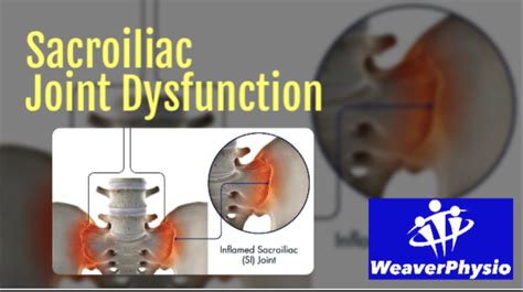 Sacroiliac Joint Dysfunction