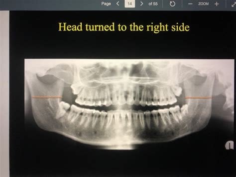 Panoramic Errors Flashcards Quizlet