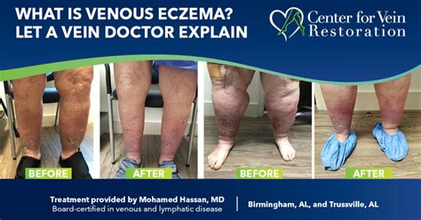 Venous Eczema Diagnosing Lipodermatosclerosis