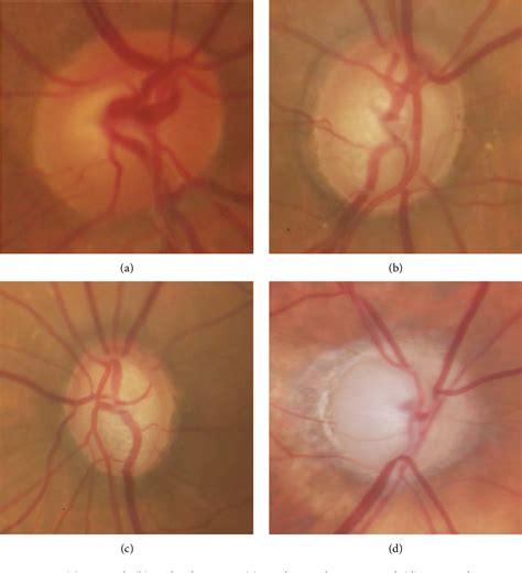 Figure 1 From Glaucoma Detection Using Image Processing And Supervised Learning For