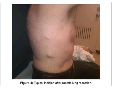 Advances Robotics Automation Robotic Lung Resection