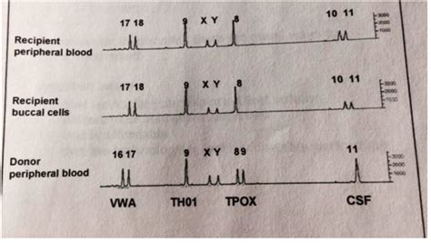 Solved Based On The Following Str Based Bone Marrow