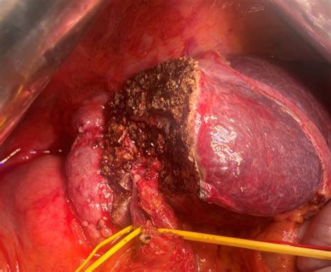 Right Hemihepatectomy For Intrahepatic Cholangiocarcinoma