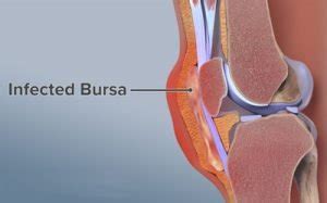 Knee Bursitis Treatment In Nyc Knee Pain Doctors Specialists New York