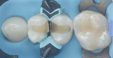 Back To Back Class Ii Restorations With The Quad Matrix System From