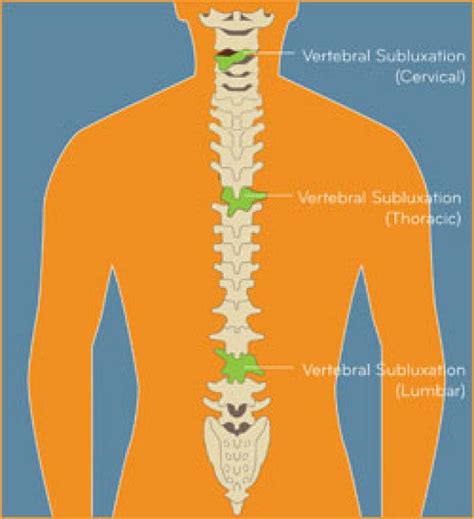 What Is A Vertebral Subluxation Woodbury Mn Patch