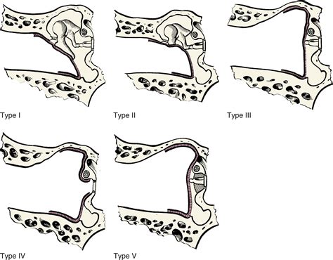 Ossicular Chain Reconstruction Clinical Tree