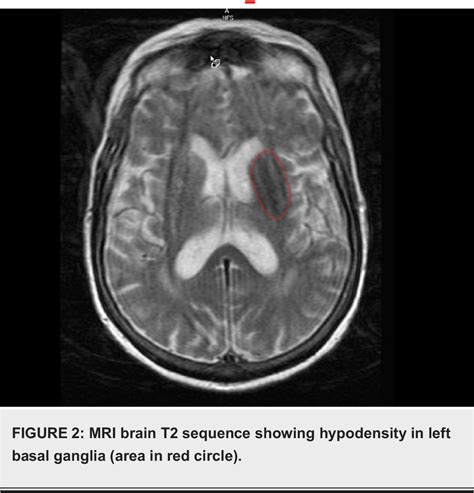 Figure 1 From Hemichorea Induced By Non Ketotic Hyperglycemia In A Caucasian Woman Semantic