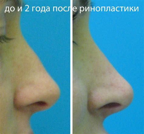 Нос после ринопластики по месяцам - 78 фото