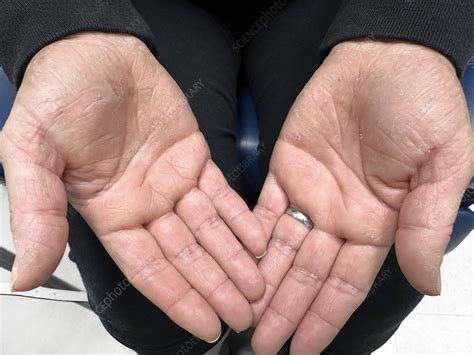 Palmoplantar Psoriasis Stock Image C0613046 Science Photo Library