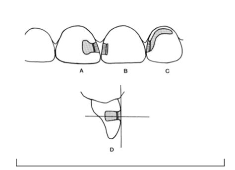 Comprehensive Overview Of Anterior Restorations On Primary Teeth And