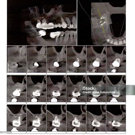 Xray Of Unhealthy Teeth On The Right Side Of The Mouth Of A 60yearold