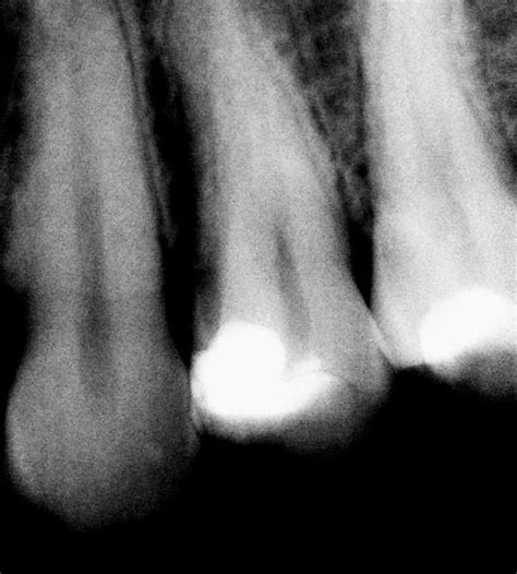 The Radiograph Verifies The Absence Of An Overhang At The Cavosurface