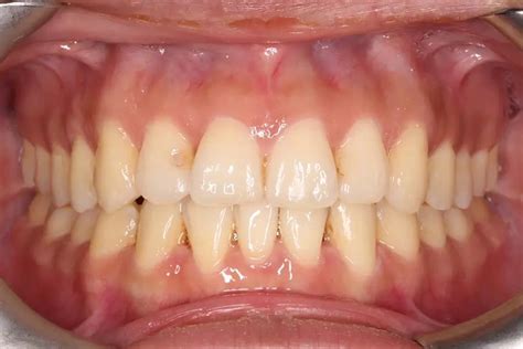 Lower Incisor Extraction Orthodontist Vaughan Braces Vaughan