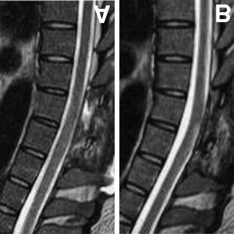 T 2 Weighted Magnetic Resonance Images Obtained At 3 Months A And 1
