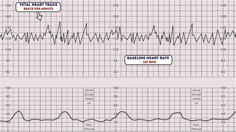 How To Read A Ctg Ctg Interpretation Geeky Medics
