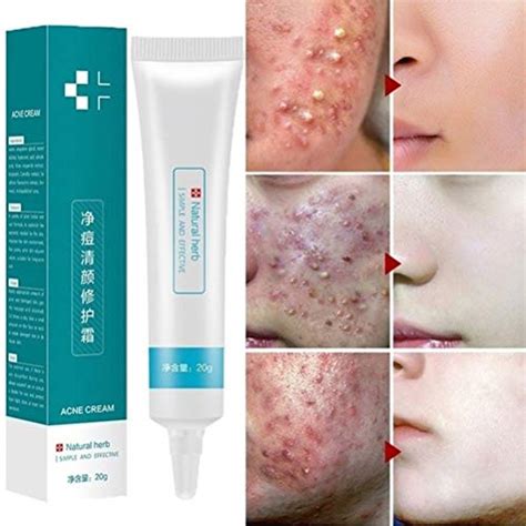 Eritromicina Pomada Para Acne • Toallitas Para El Acné Guía De Compra