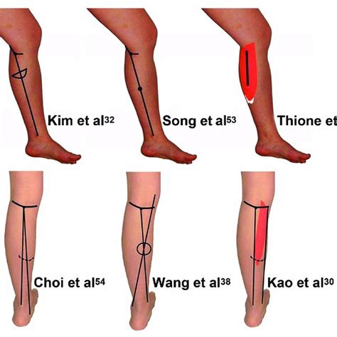 The Medial Sural Artery Perforator Msap Free Flap For Resurfacing The