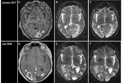 Post Gadolinium Magnetic Resonance Imaging Mri T1 Download