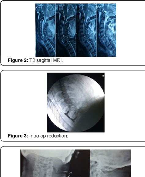 Figure 3 From Cervical Facet Fracture Dislocations Management Algorithm And Tips For Reduction