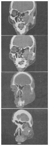 男，65岁，左眼球突出近1年，鼻涕带血，面颊部隆起，同时面颊部有麻木感，ct检查如图最可能的诊断是（）。 A上颌窦息肉 B上颌窦血管瘤 C上颌窦囊肿 D上颌窦癌 E骨肉瘤 自考题库