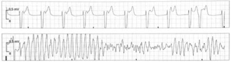 Delayed Occurrence Of An Accelerated Idioventricular Rhythm With