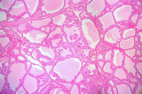Multinodular Goiter Histology