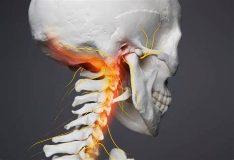 Adherent Nerve Root Archives Orthopaedic Manipulation