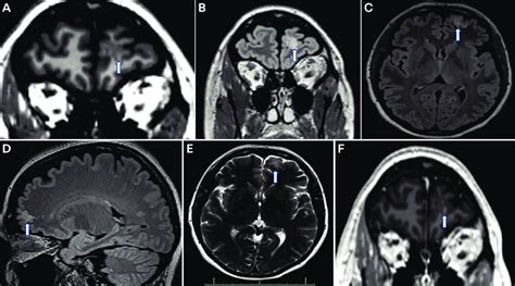 Imaging From The Patient In Case 5 2 Showing Left Prefrontal Cortex Download Scientific Diagram
