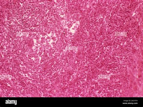 Crohns Disease Light Micrograph Of A Section Through A Small