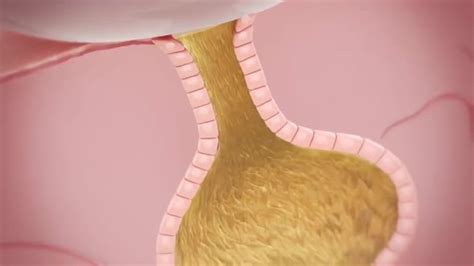 Acne And Pimples Stages Of Development Graphic Animation Motion Graphics