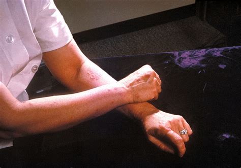 Eritema Nodoso Foto Cause Sintomi E Cura Valori Normali