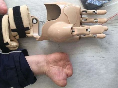 Silicone Partial Hand Prosthesis Myoelectric At ₹ 22000 In Mumbai