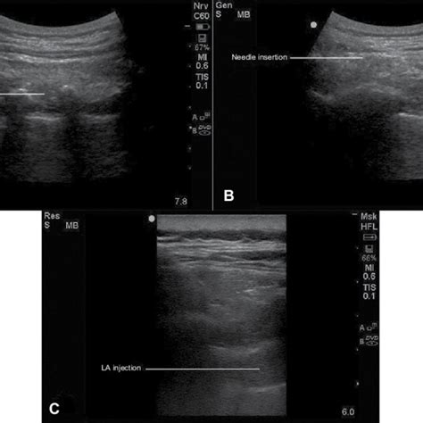 Technique Of Paravertebral Block A Localization Of Pvs B Needle Download Scientific