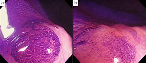 Magnifying Endoscopy With 005 Crystal Violet Staining Showed Iiil
