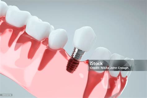 턱뼈에가는 치아 임플란트의 3d 이미지 치아 임플란트에 대한 스톡 사진 및 기타 이미지 치아 임플란트 이빨 모형 Istock